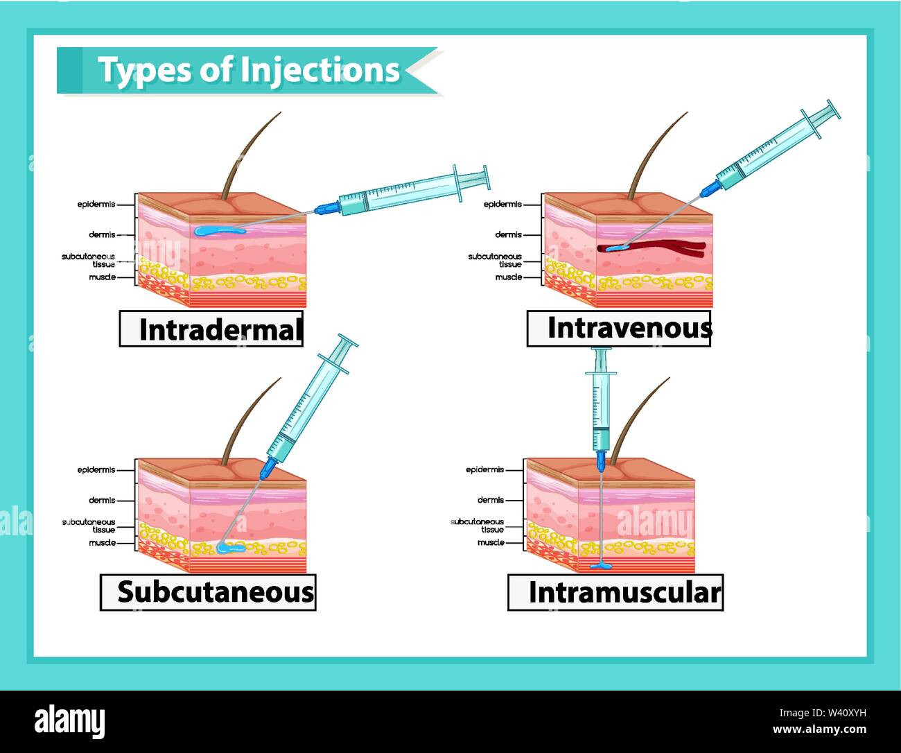 Scientific medical illustration of types of injections illustration ...