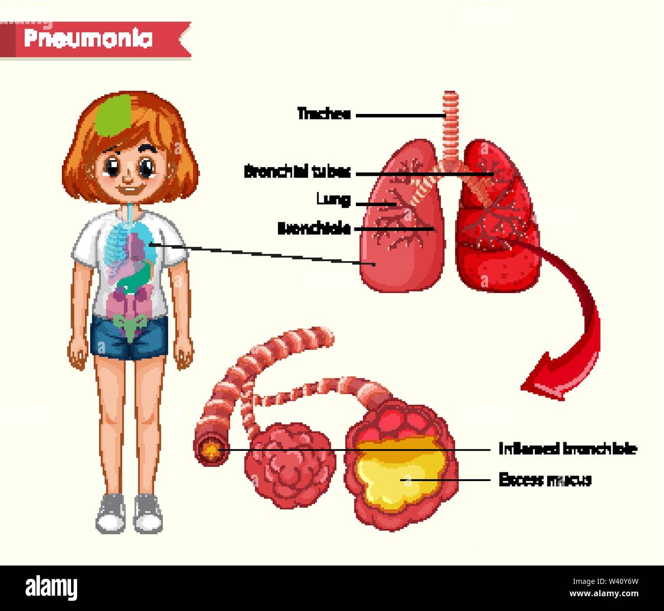 Scientific medical illustration of pneumonia concept illustration Stock ...