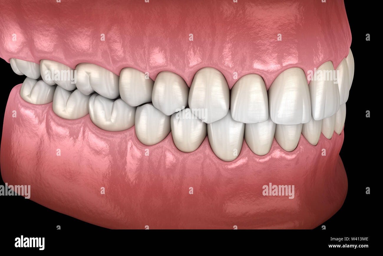 Healthy human teeth with normal occlusion, side view. Medically ...