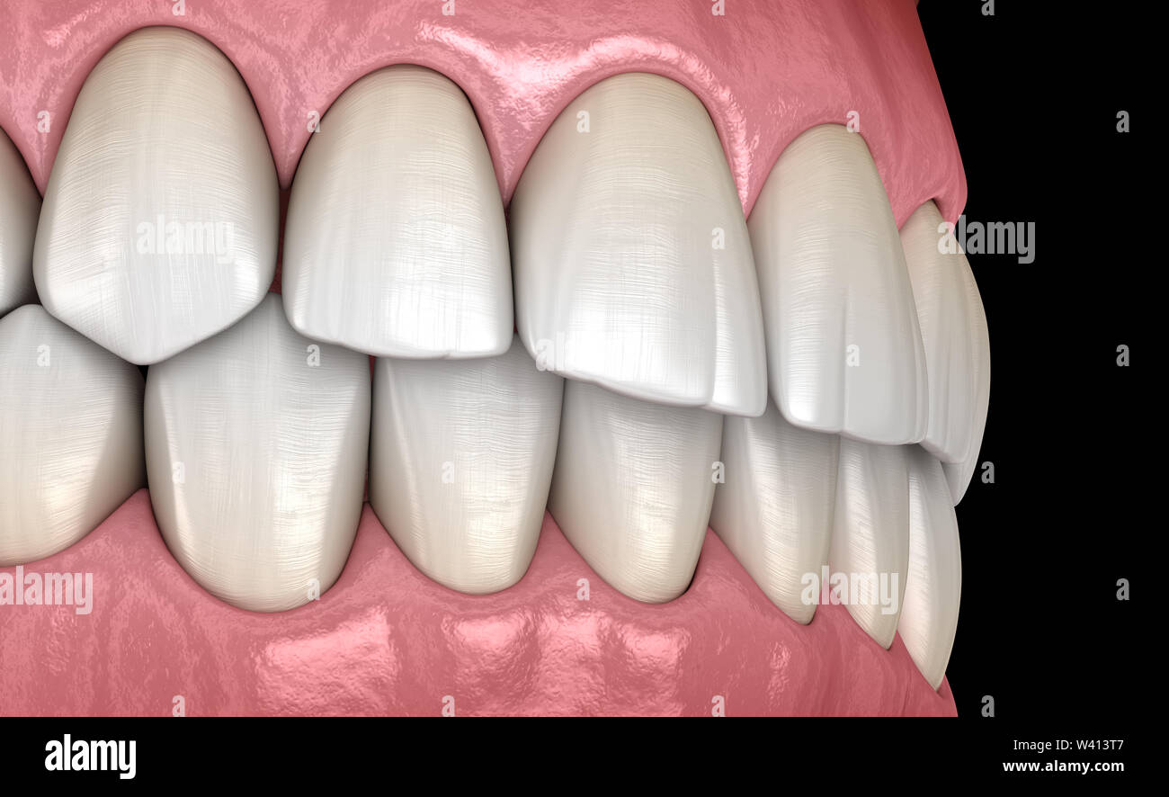 What Is Normal Dental Occlusion at Darcy Spaull blog