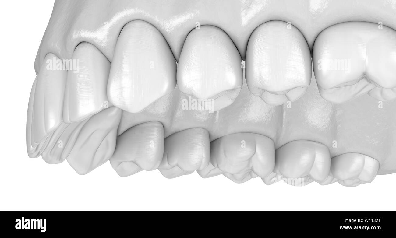 Upper maxillary bone Black and White Stock Photos & Images - Alamy