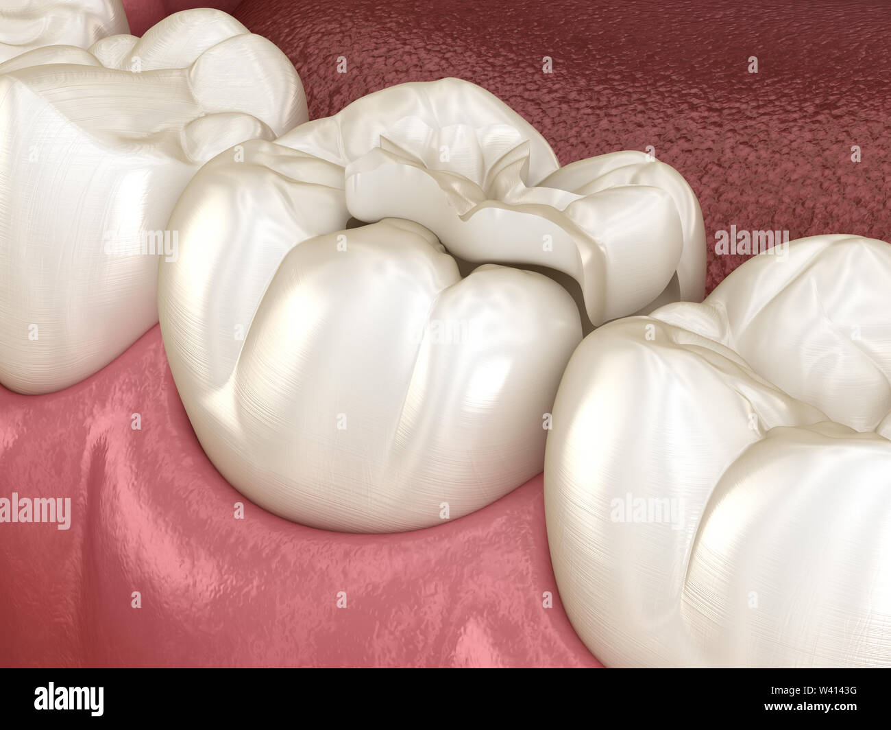Inlay ceramic crown fixation over tooth. Medically accurate 3D ...