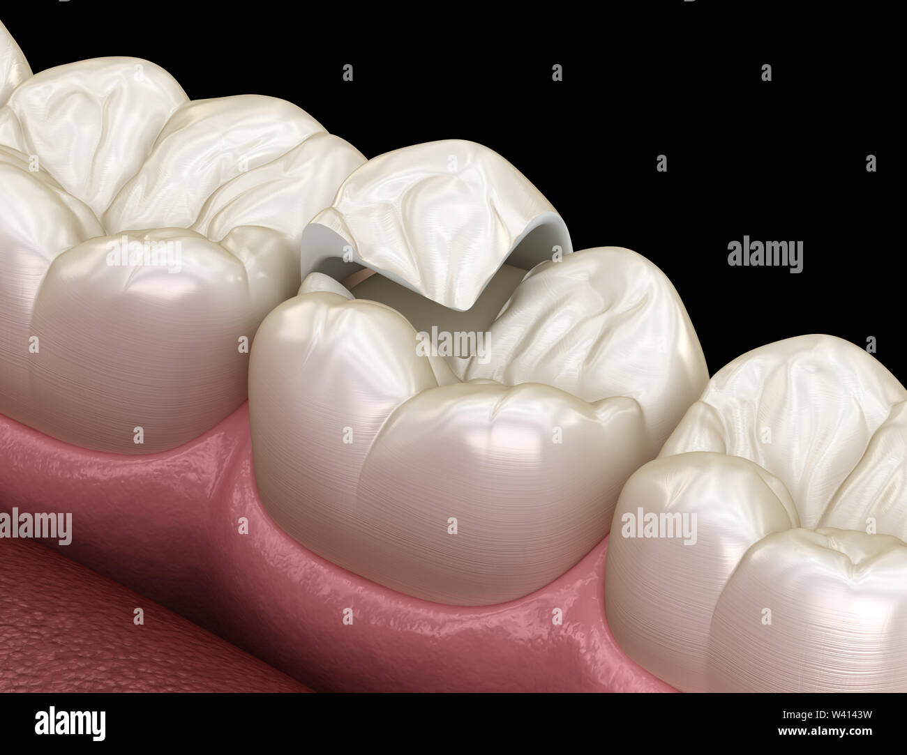 Onlay ceramic crown fixation over tooth. Medically accurate 3D ...
