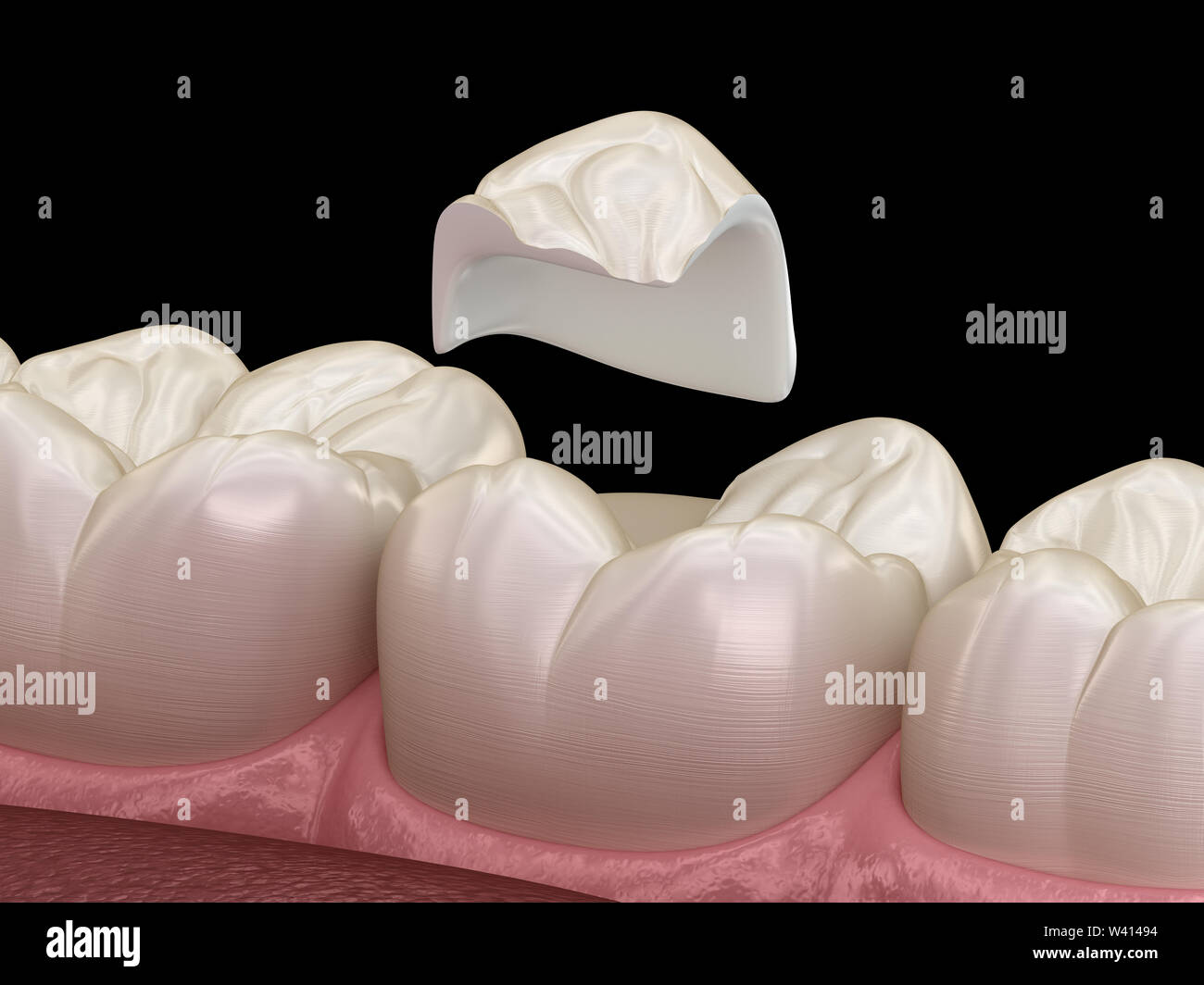 Onlay ceramic crown fixation over tooth. Medically accurate 3D ...