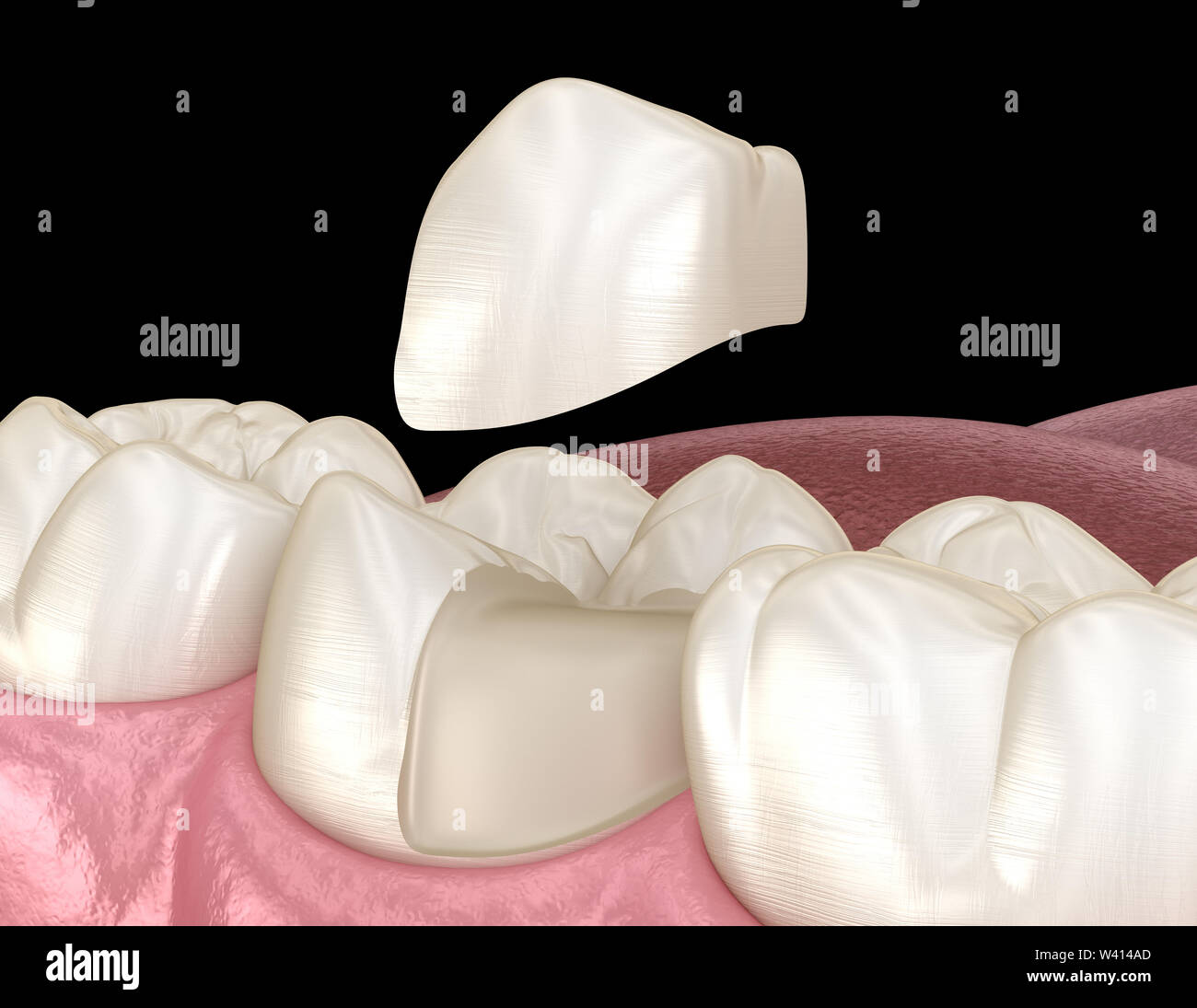 Onlay ceramic crown fixation over tooth. Medically accurate 3D ...