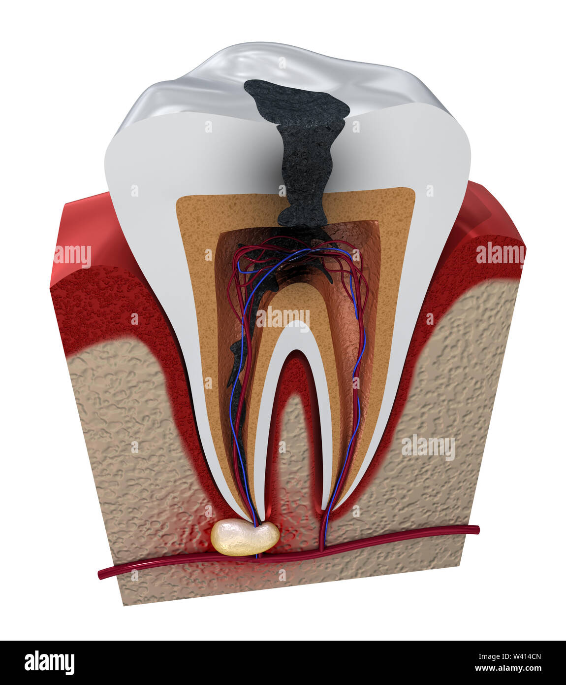 Tooth decay. Medically accurate tooth 3D illustration Stock Photo - Alamy