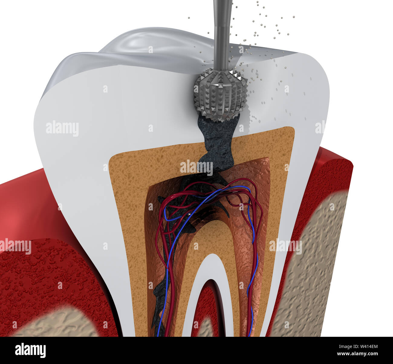 Root canal treatment process. 3D illustration Stock Photo - Alamy