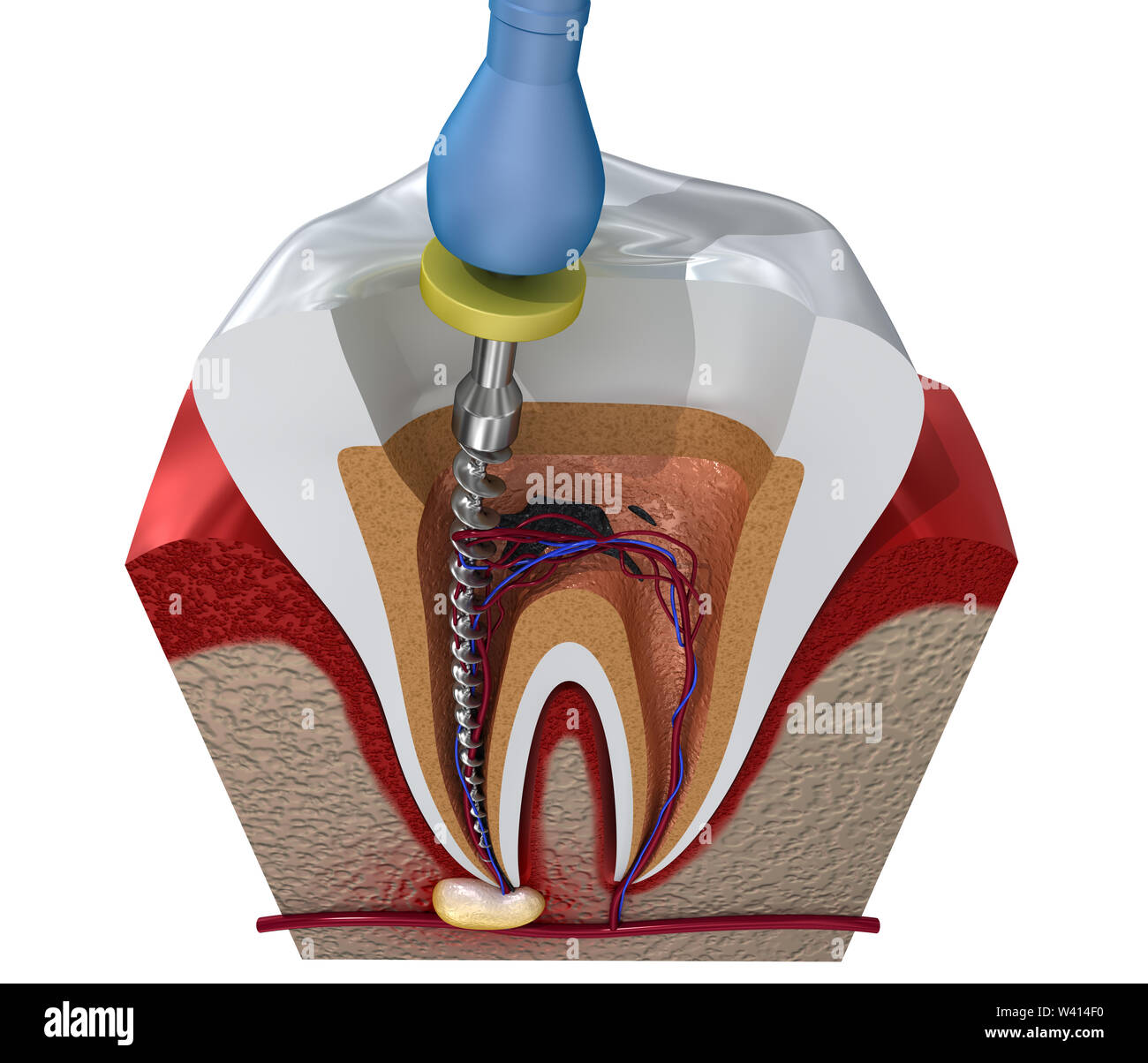 Root canal treatment process. 3D illustration Stock Photo - Alamy