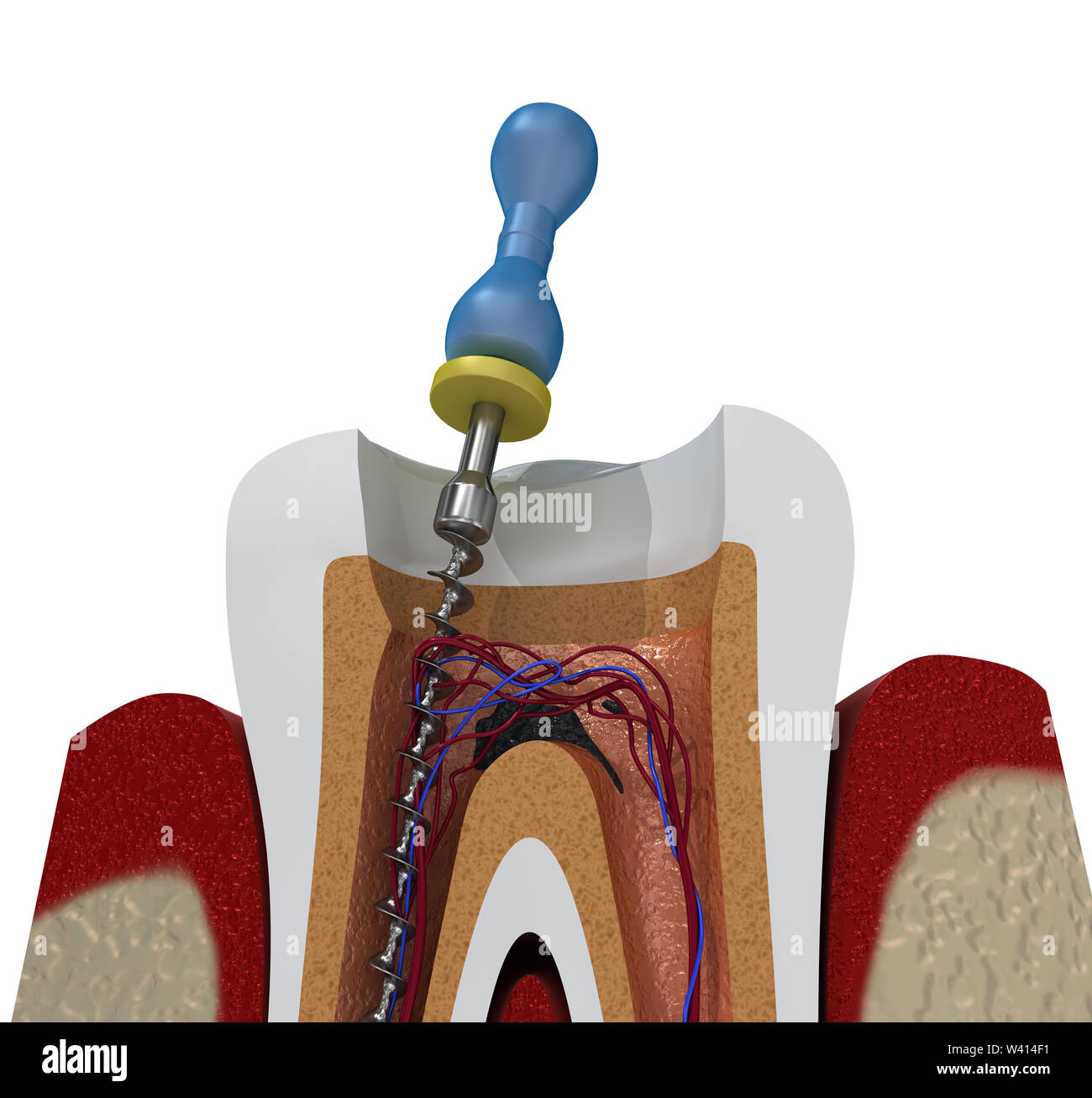 Root canal treatment process. 3D illustration Stock Photo - Alamy