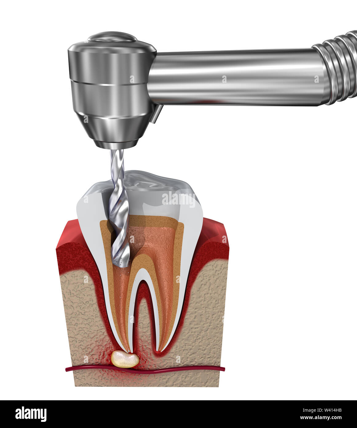 Root canal treatment process. 3D illustration Stock Photo - Alamy