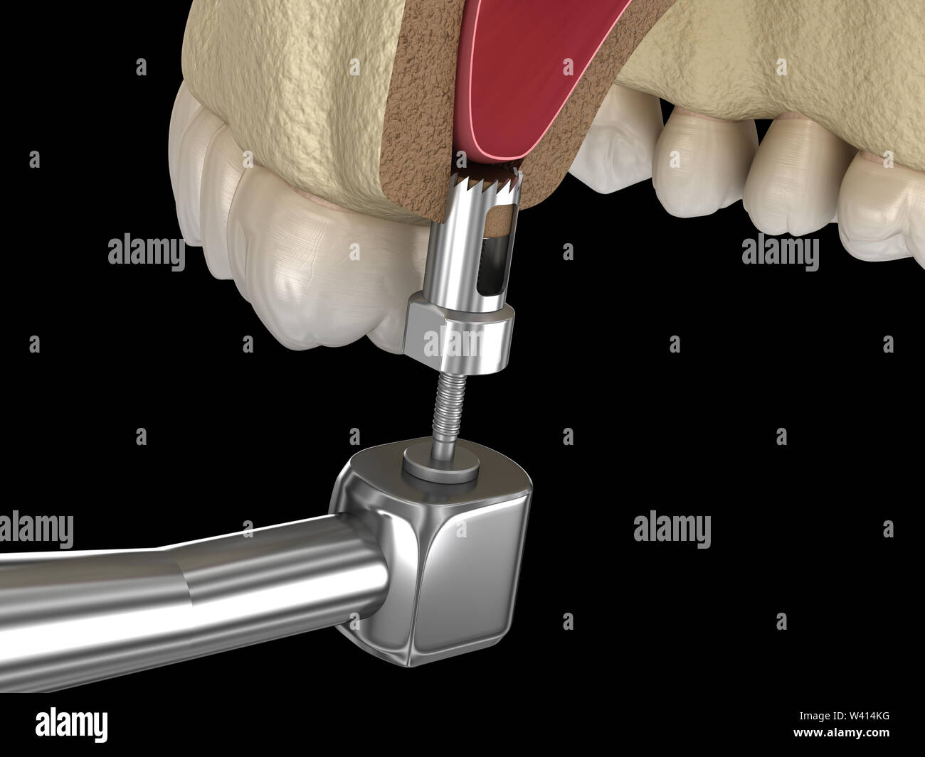 Sinus Lift Surgery - Creating an access to the Sinus. 3D illustration ...