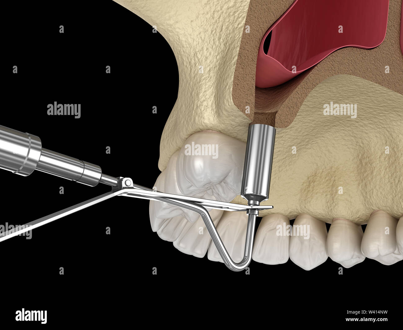 Sinus Lift Surgery - Adding new bone. 3D illustration Stock Photo - Alamy