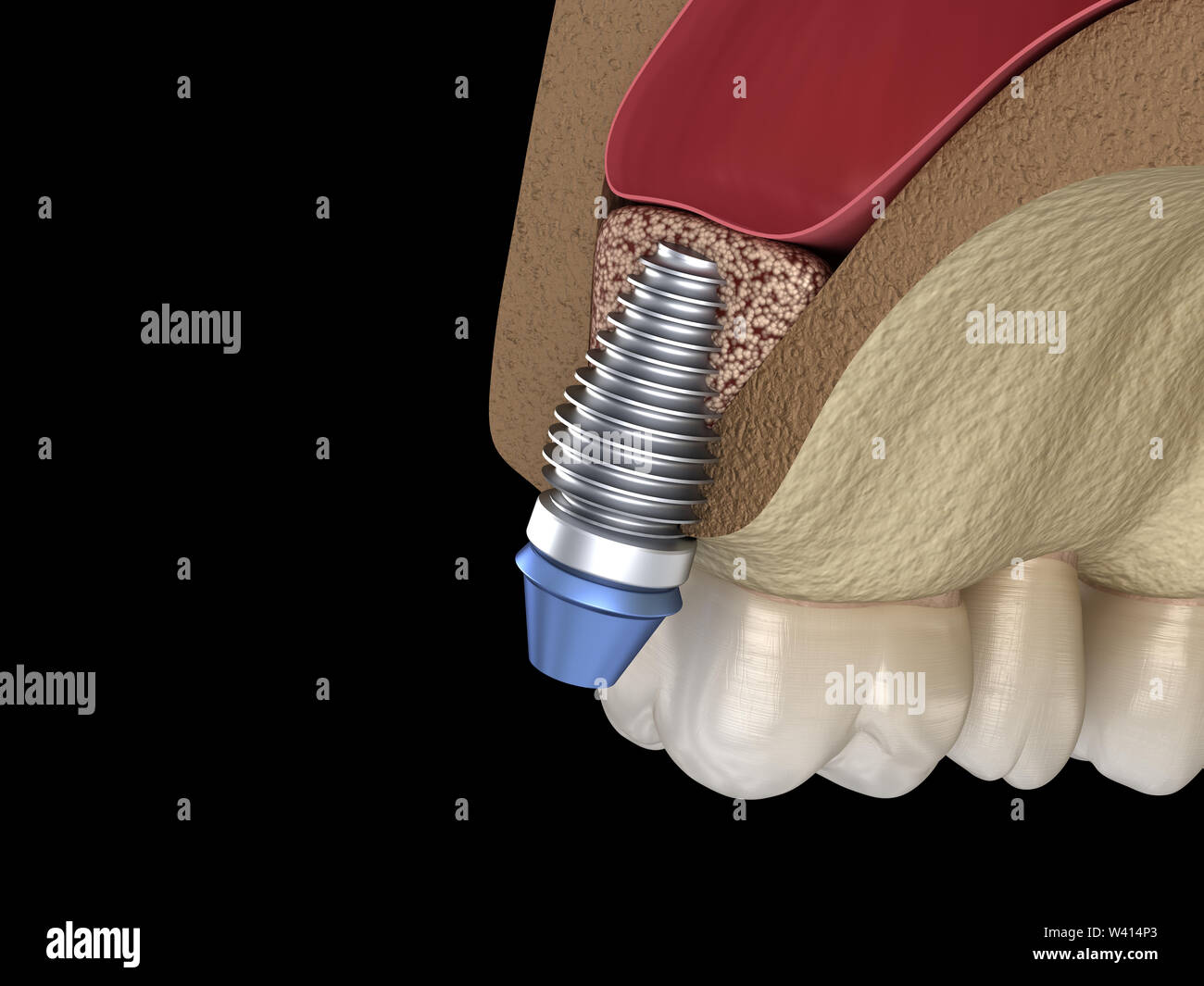 Sinus Lift Surgery - implant installation. 3D illustration Stock Photo ...
