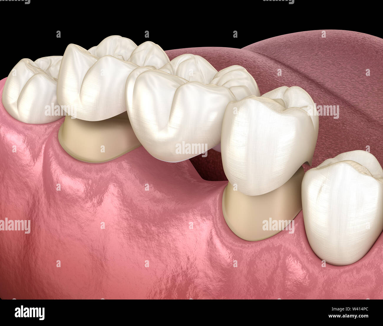 Dental bridge of 3 teeth over molar and premolar. Medically accurate 3D ...