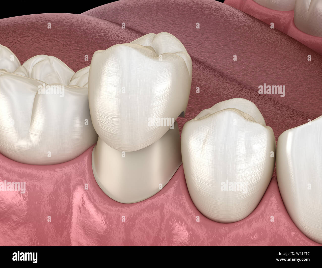 Dental crown premolar tooth assembly process. Medically accurate 3D ...