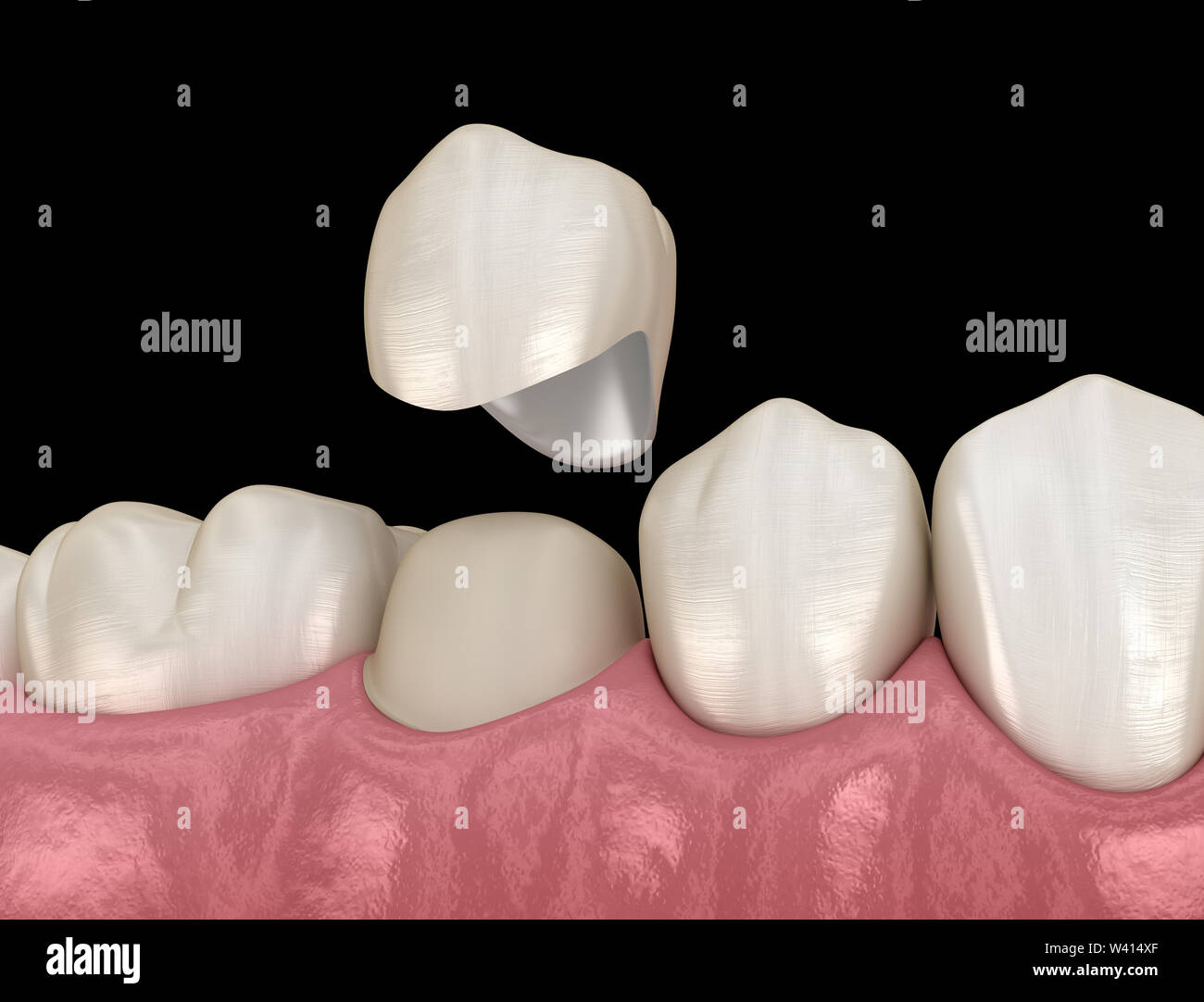 Dental crown premolar tooth assembly process. Medically accurate 3D ...