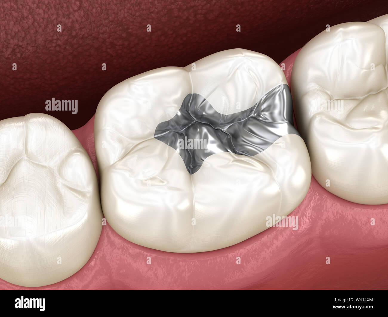 Silver inlay hi-res stock photography and images - Alamy