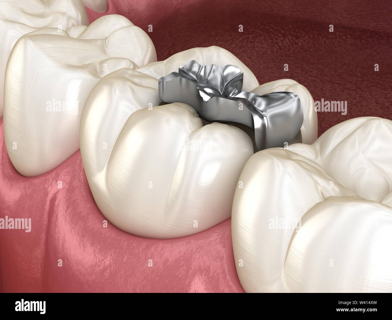 Inlay onlay hi-res stock photography and images - Alamy