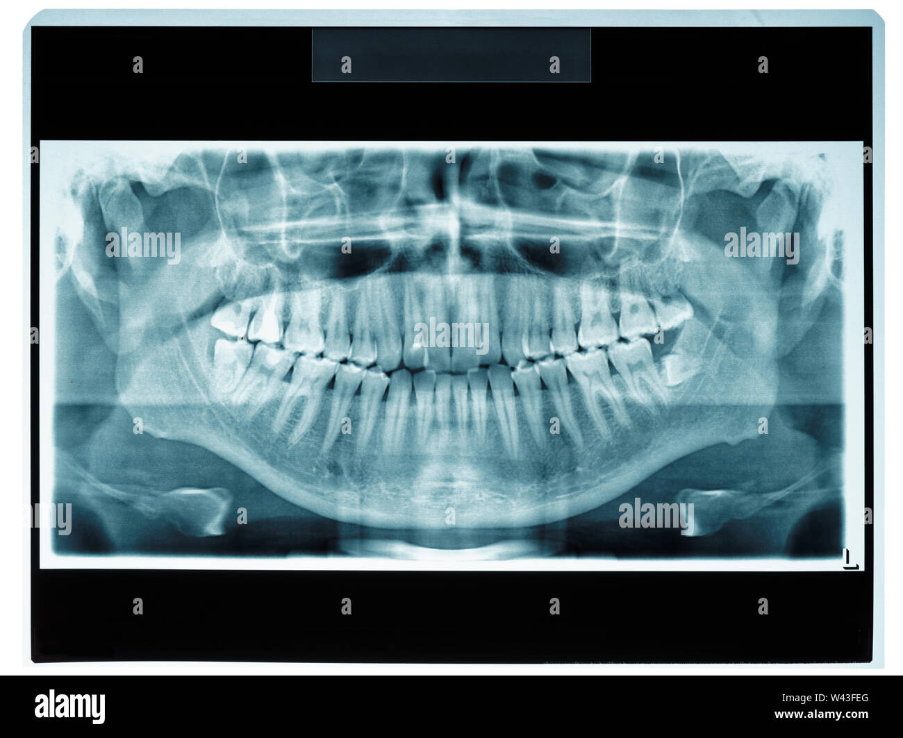Impacted teeth hi-res stock photography and images - Alamy