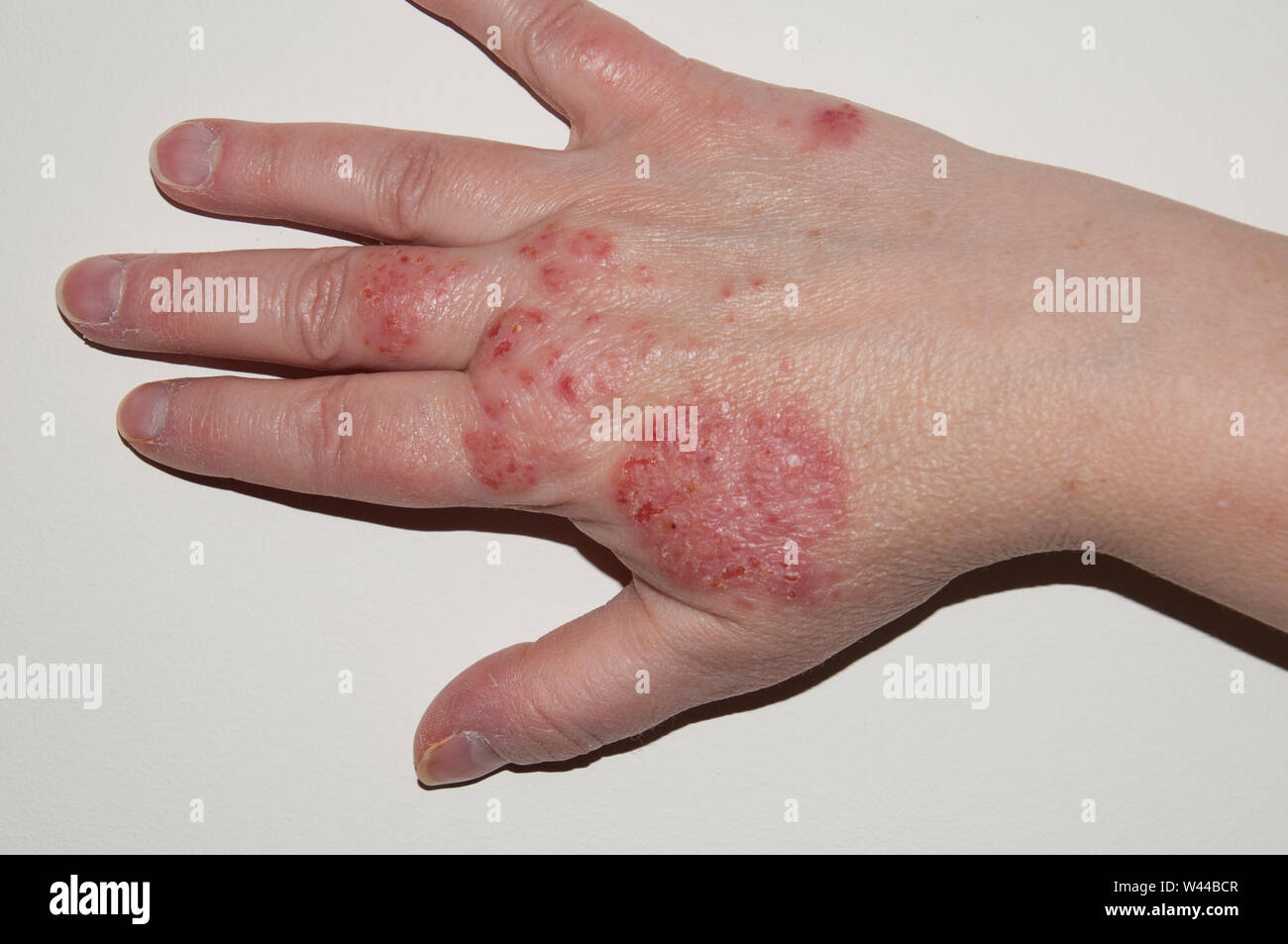 You scabs hi-res stock photography and images - Alamy