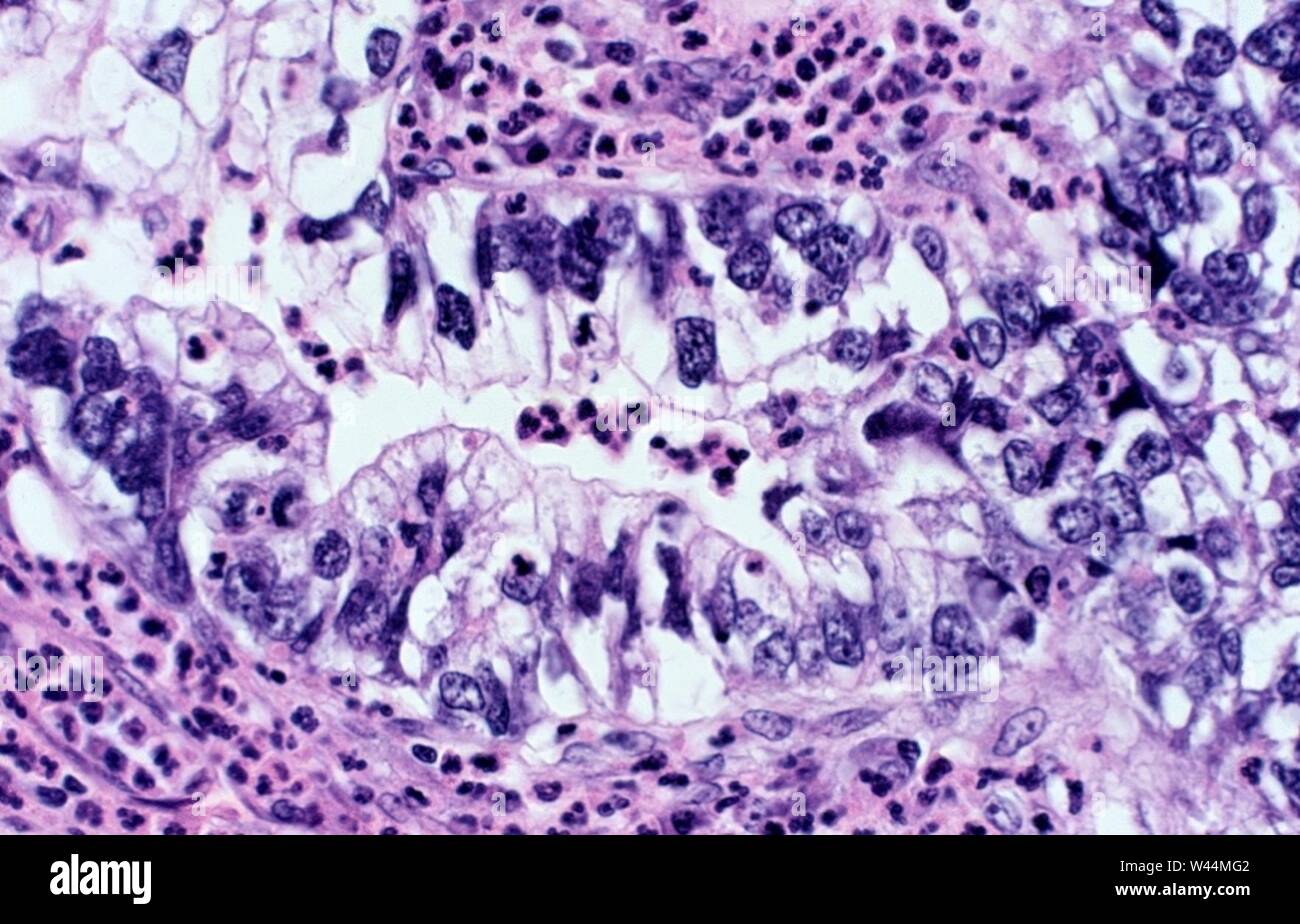 Adenocarcinoma lung hi-res stock photography and images - Alamy