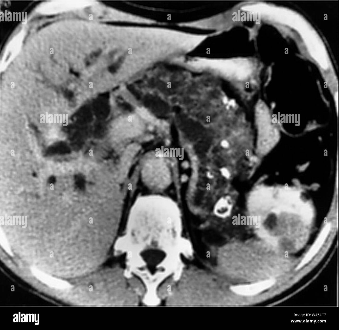 Complete replacement of the pancreas with cystic disease and ...