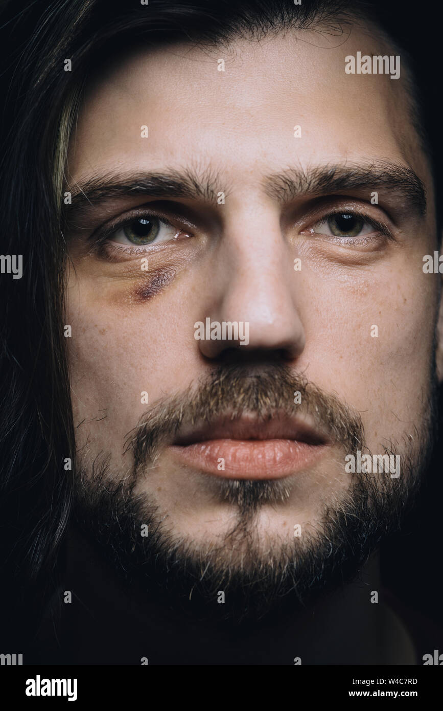 Sad man with black eye, violence domestic abuse concept Stock Photo - Alamy