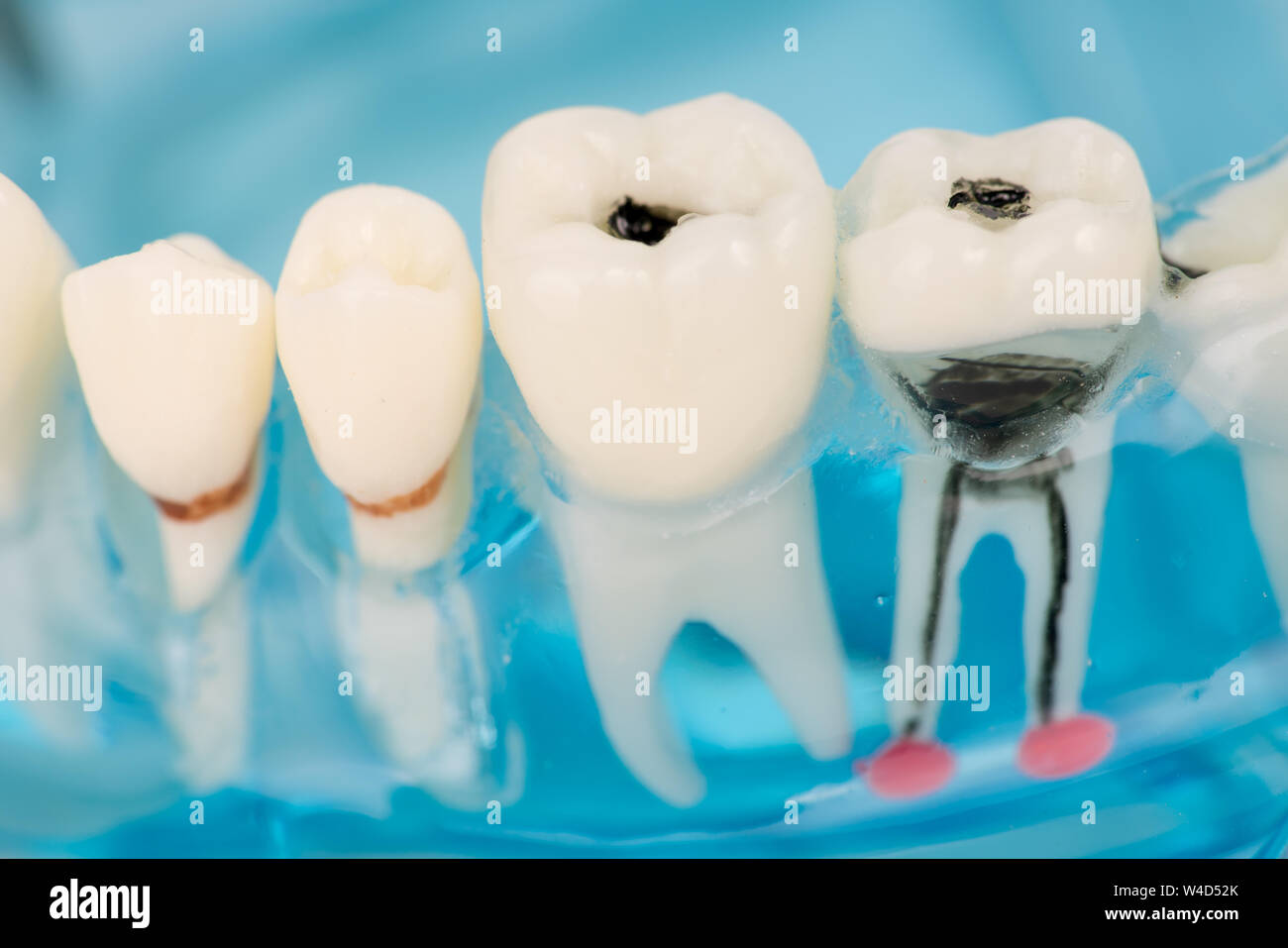 Close up of dental model and caries Stock Photo - Alamy
