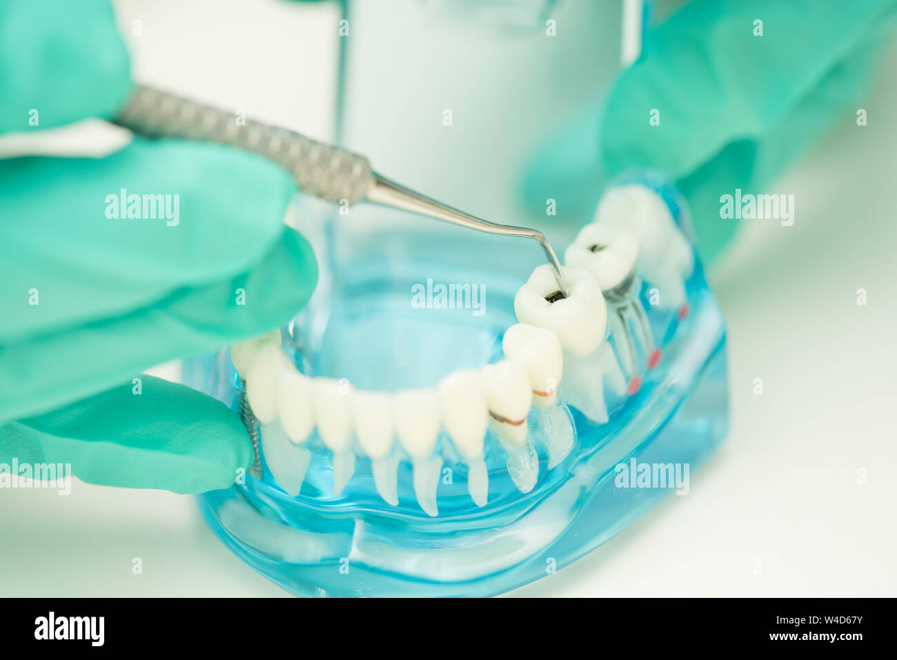 Caries cleaning hi-res stock photography and images - Alamy