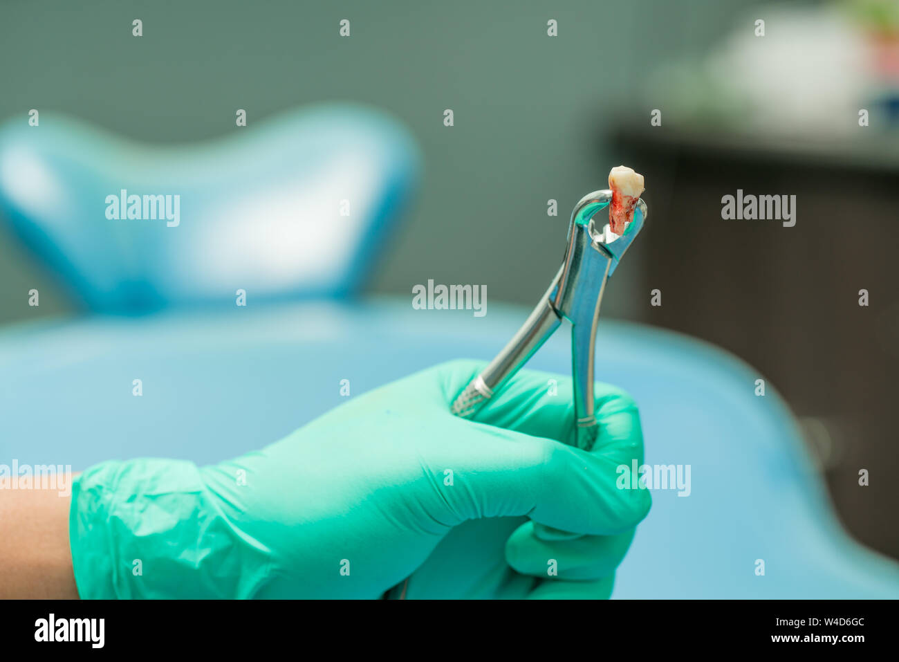 dentist hand holding clamp tooth removal in dental office background ...
