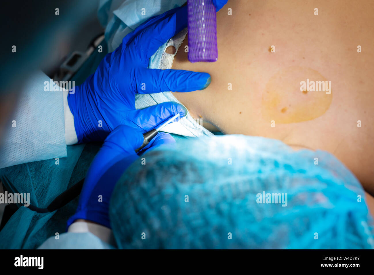 The surgeon does surgery to remove the mole on the patient's back. The ...