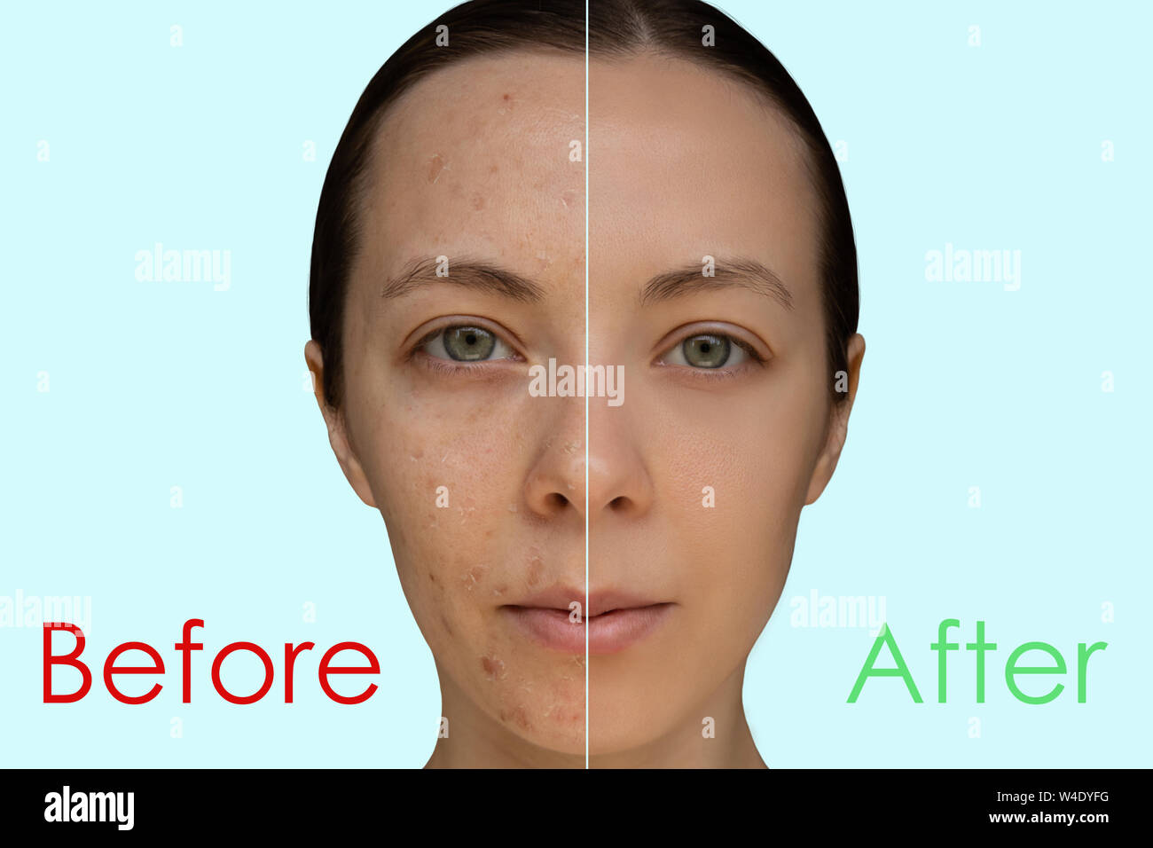Face of a young girl after a cosmetic procedure of chemical peeling ...