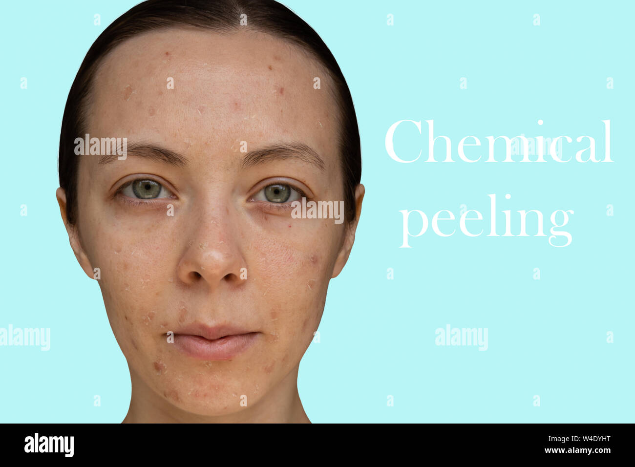 Peeling Face High Resolution Stock Photography and Images - Alamy