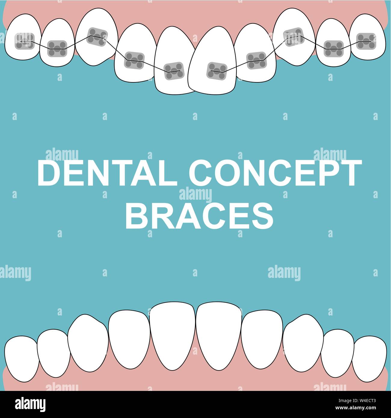 Banner Upper Braces teeth illustration vector on blue background ...