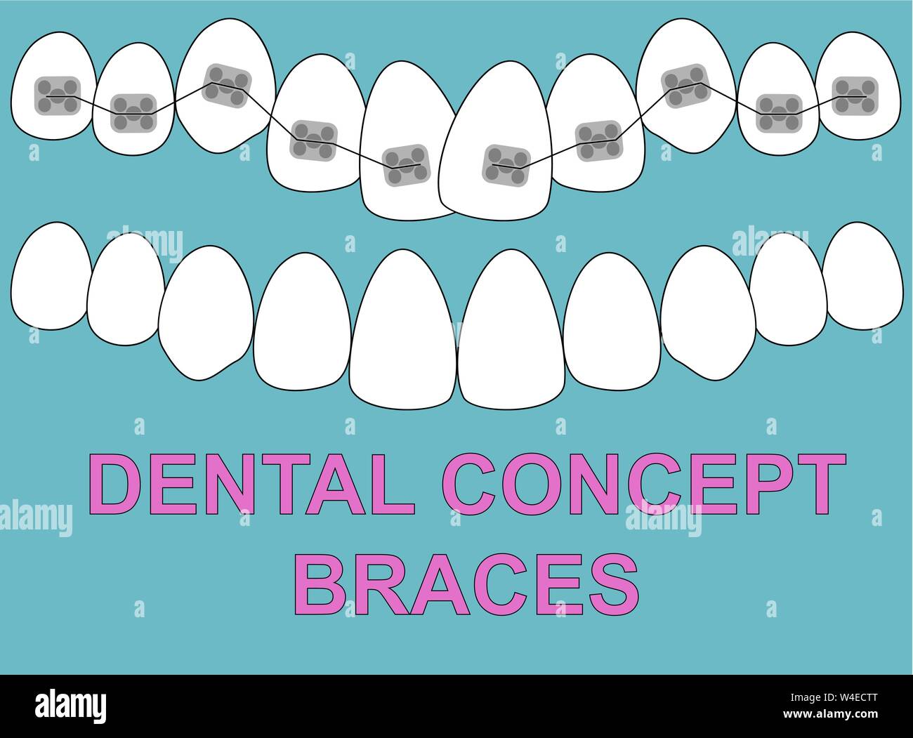 Banner Upper Braces teeth illustration vector on blue background ...