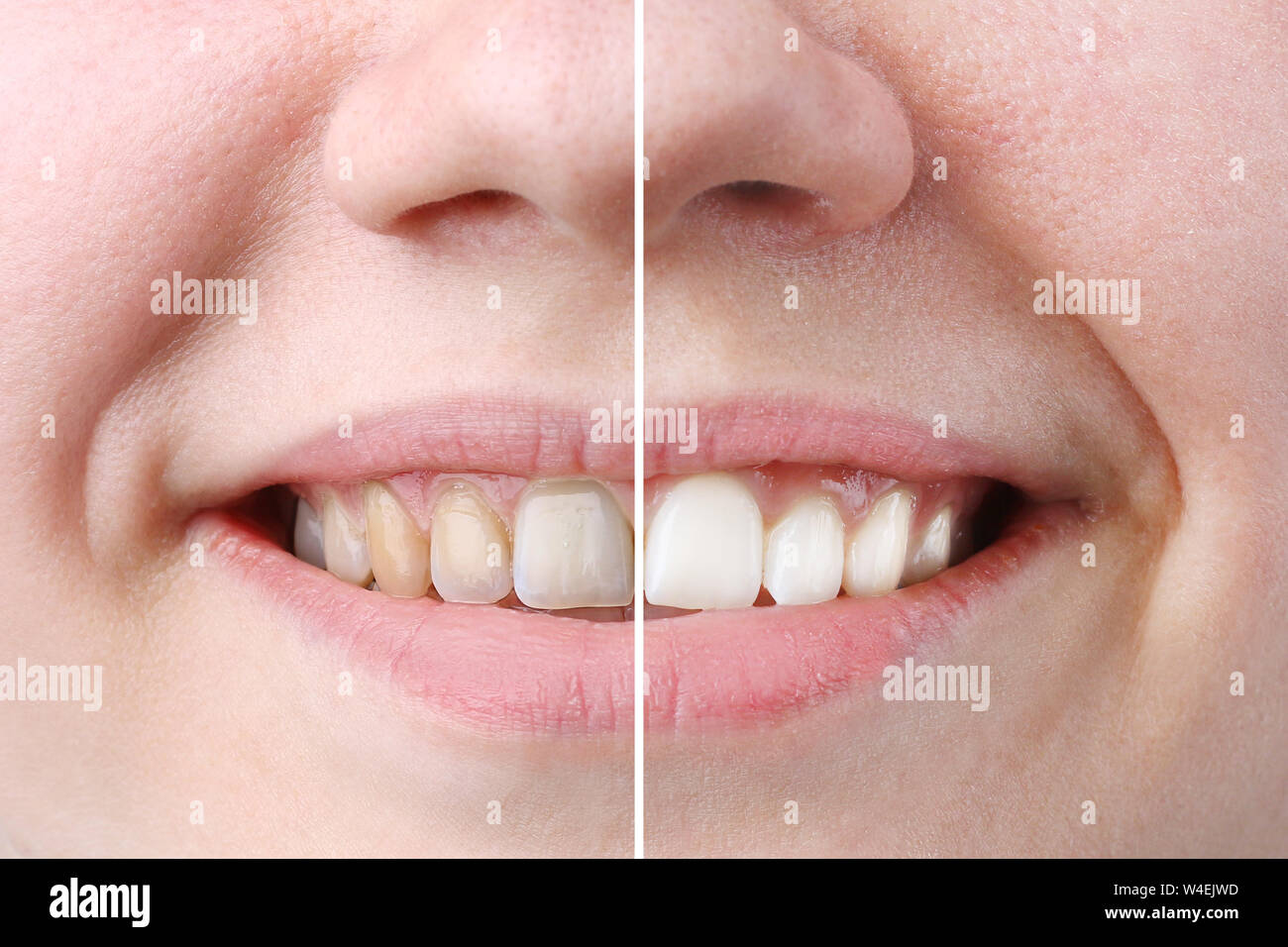 Skin bleaching before after hi-res stock photography and images - Alamy