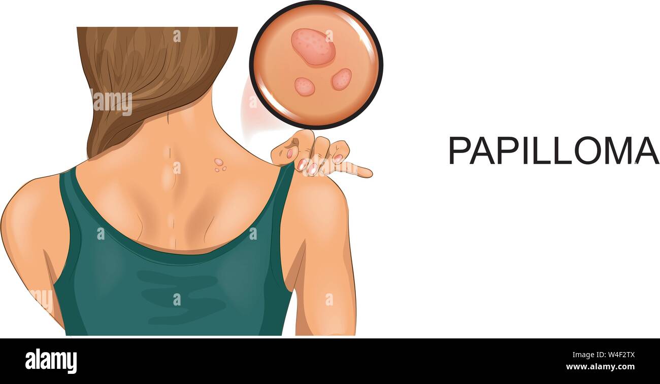 Human papilloma virus hi-res stock photography and images - Alamy