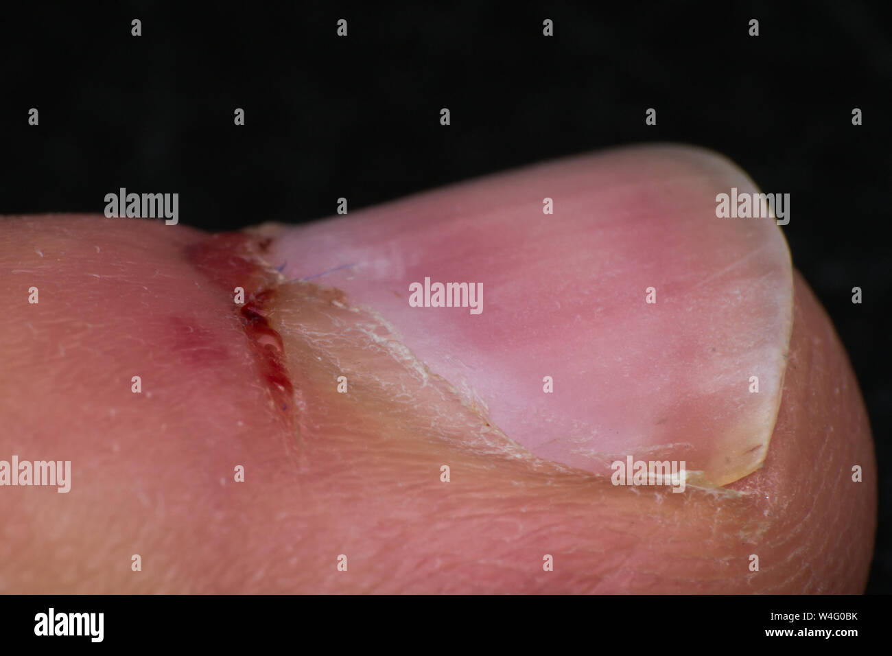 Nail wound hi-res stock photography and images - Alamy