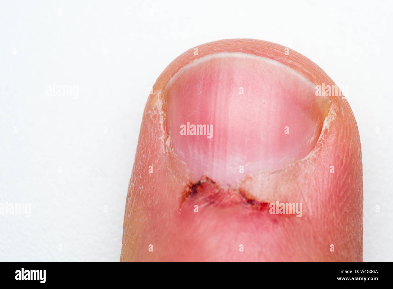 Cuticle wound hi-res stock photography and images - Alamy