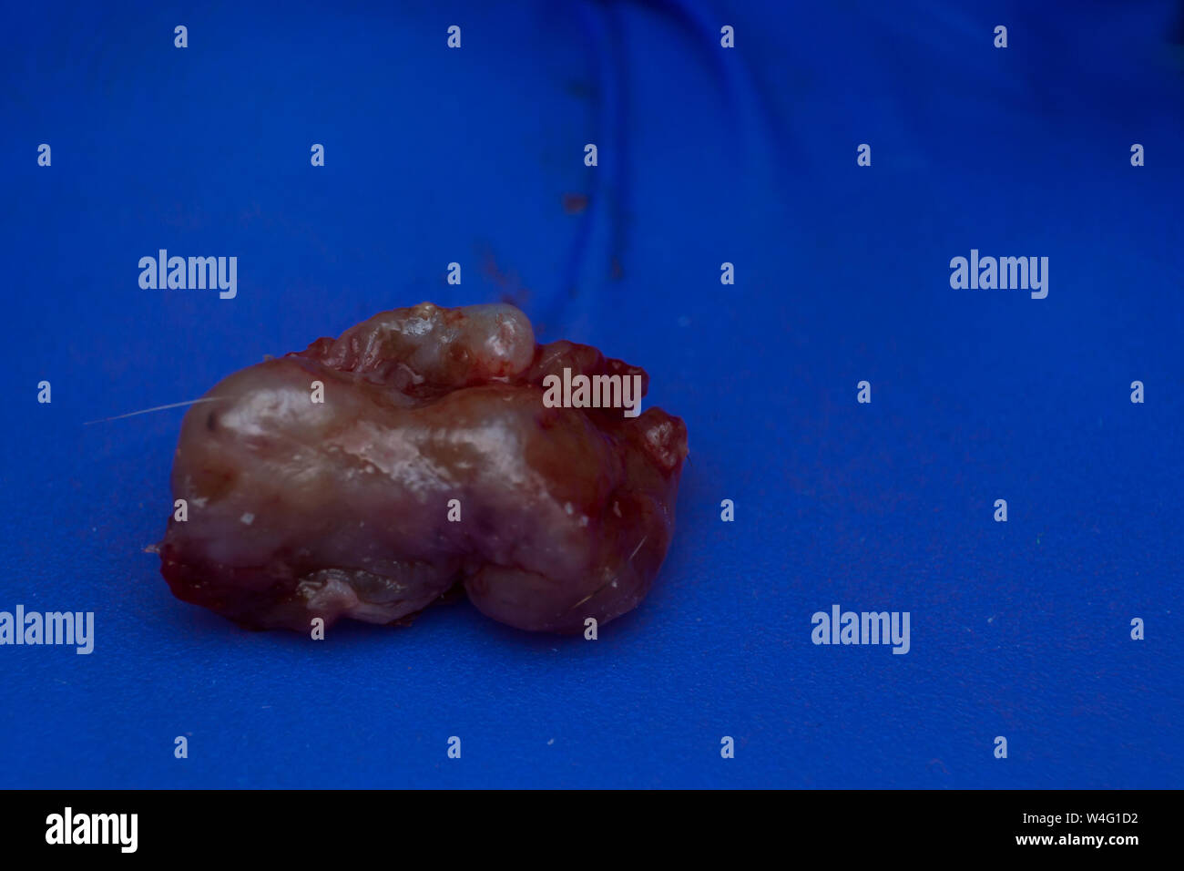 Ear cancer hi-res stock photography and images - Alamy