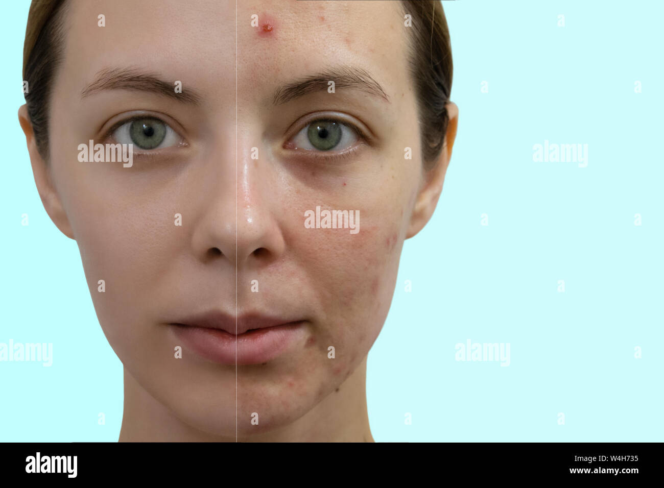 Comparison portrait of a woman with problematic skin without and with ...