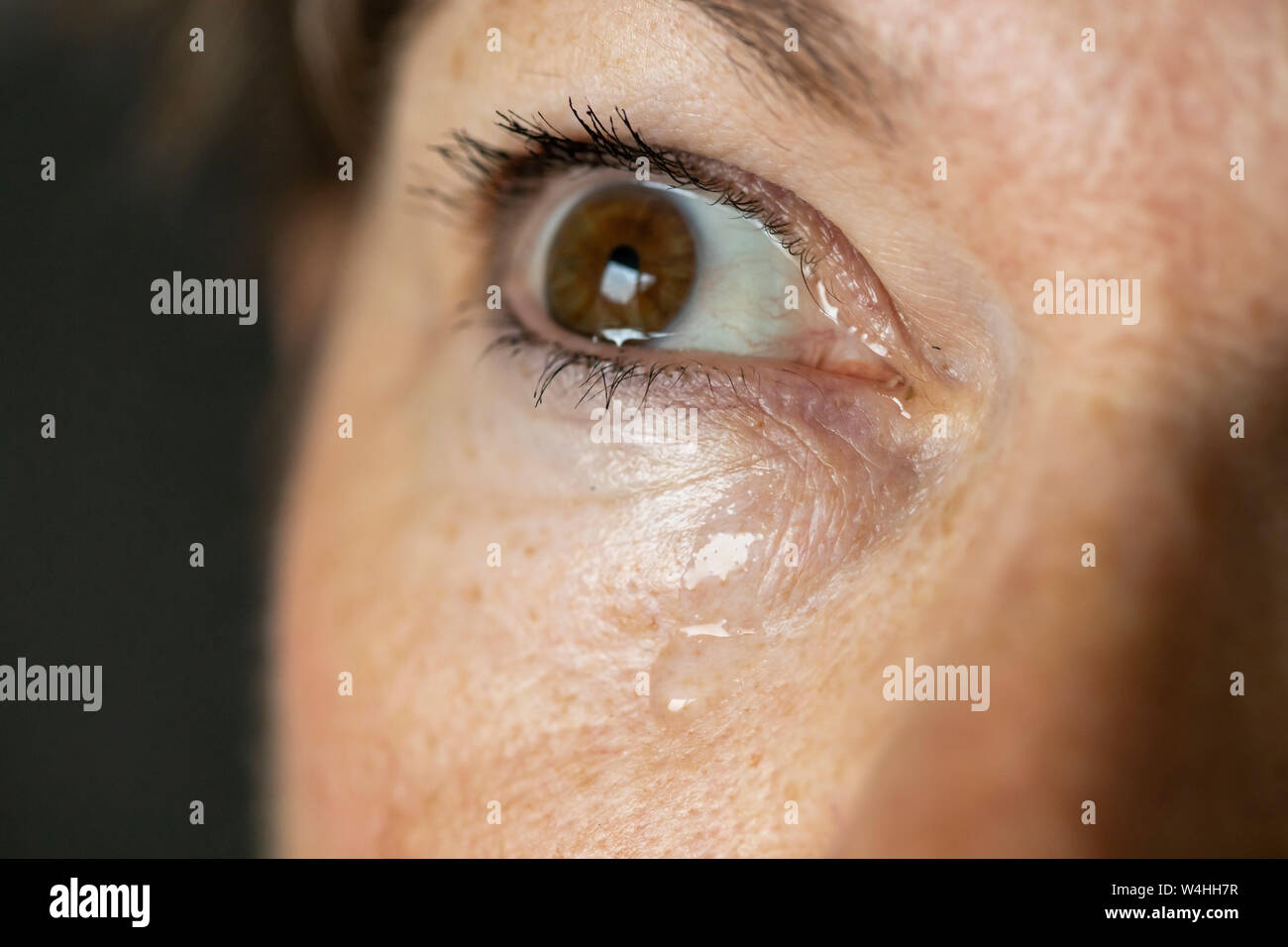 Watery eye hi-res stock photography and images - Alamy