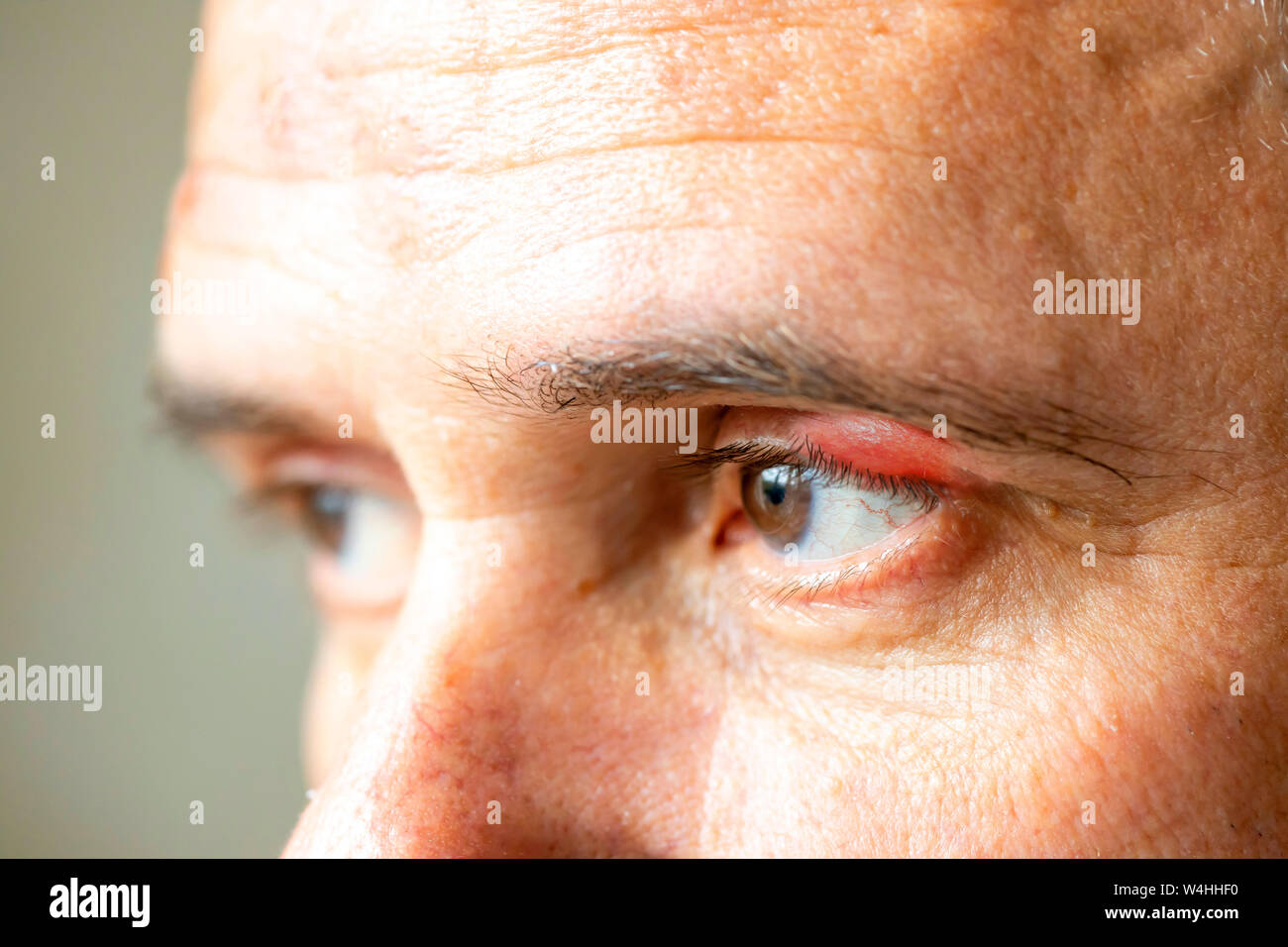 Swollen eye hi-res stock photography and images - Alamy