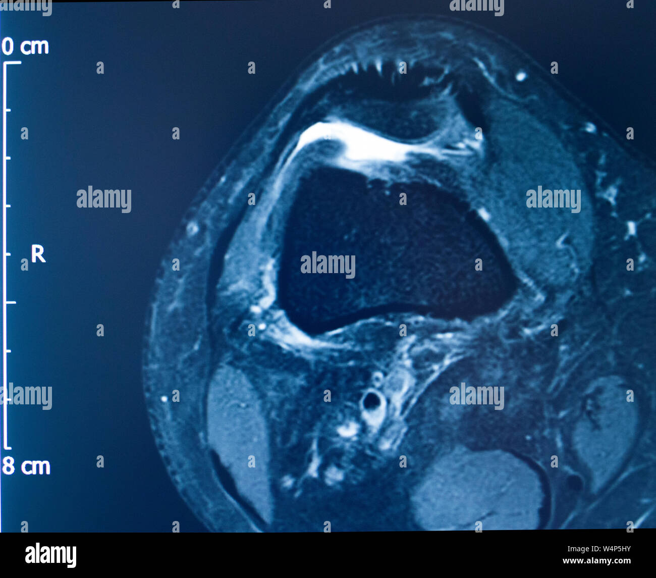 Knee sports injury mri mcl grade 2 tear magnetic resonance imaging ...