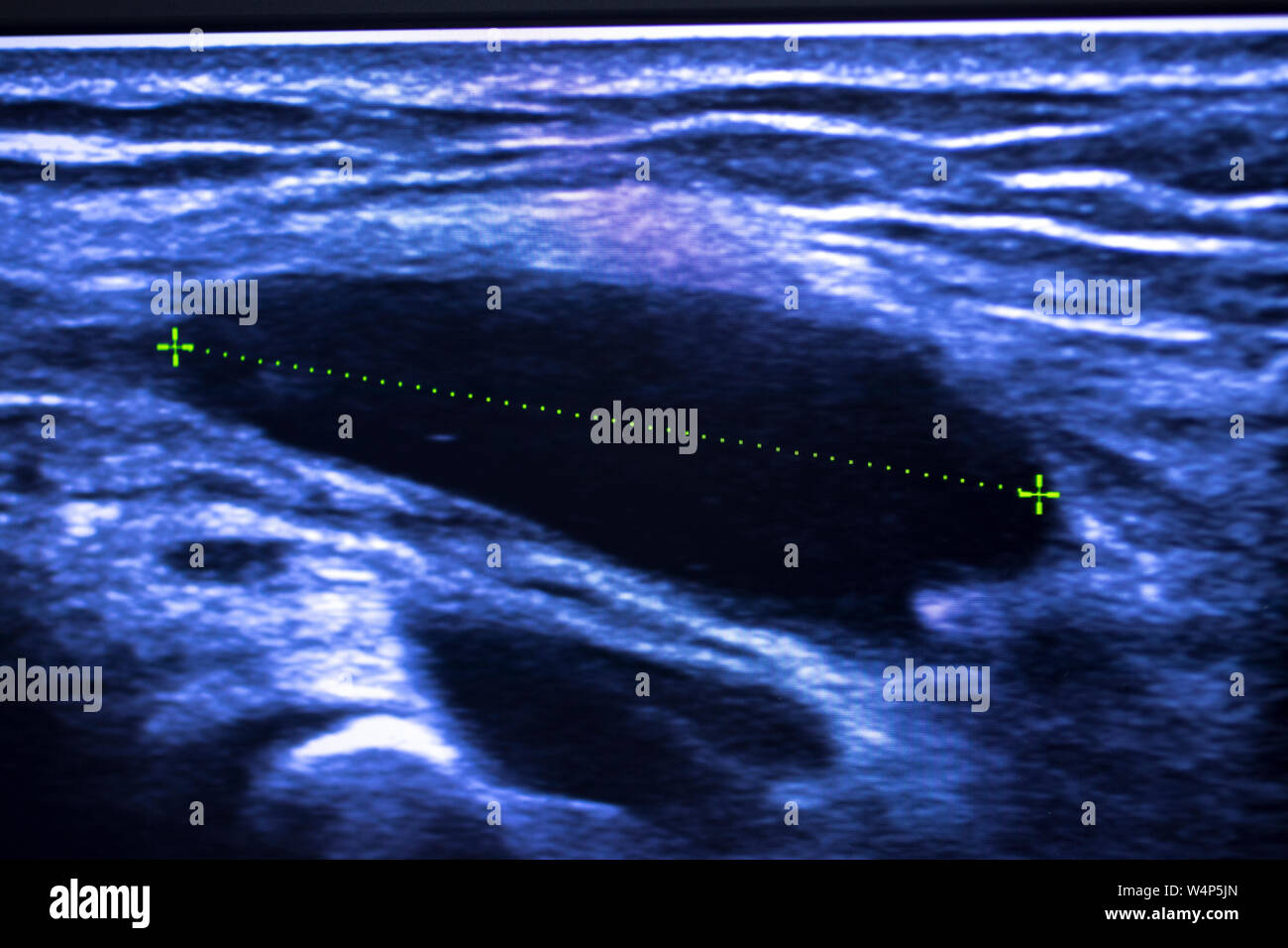 EPI Intratissue Percutaneous Electrolysis dry needling ultrasound ecography scan physiotherapy ...