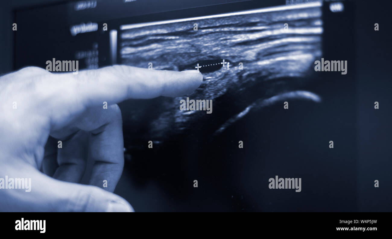 EPI Intratissue Percutaneous Electrolysis dry needling ultrasound ecography scan physiotherapy ...