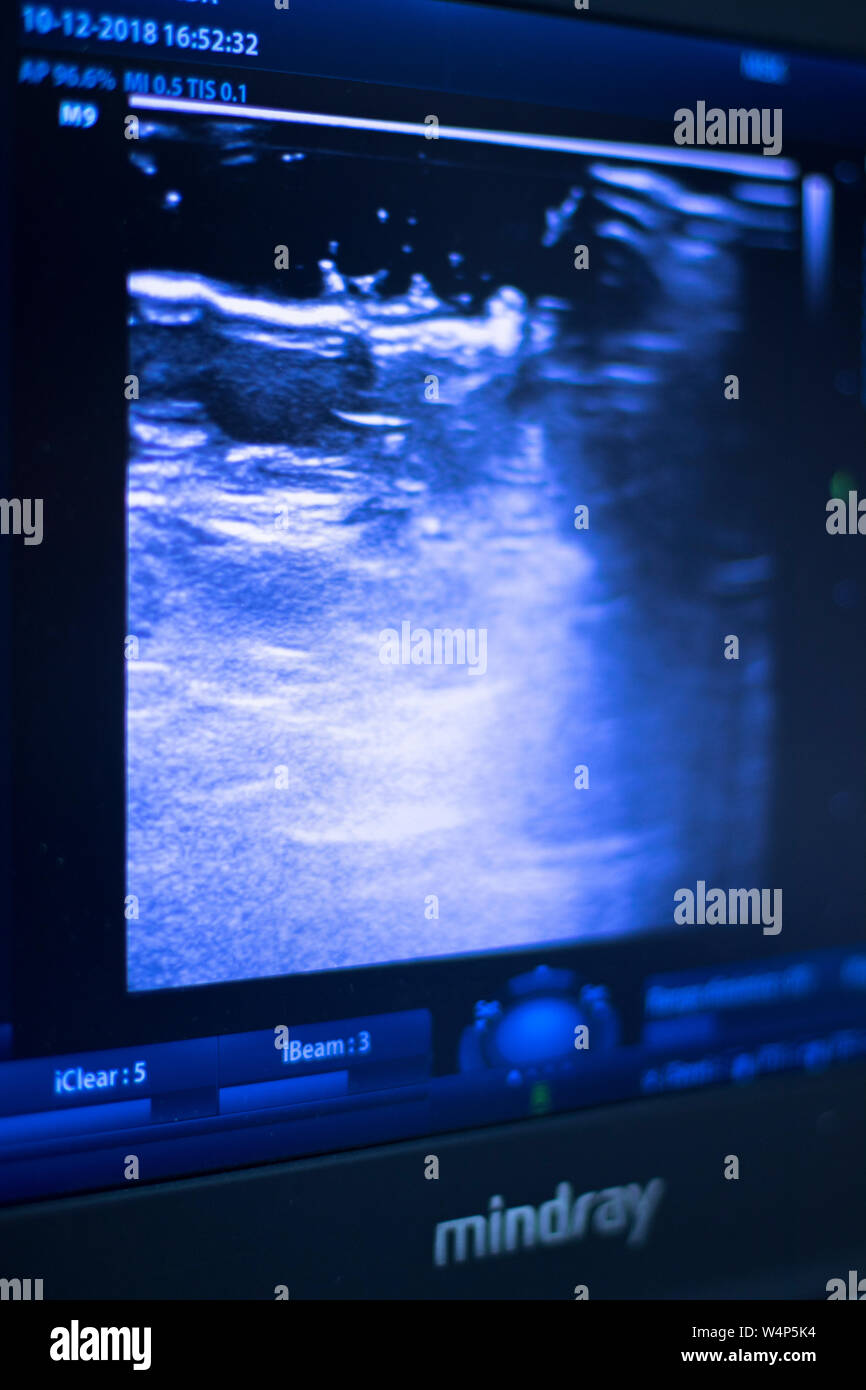 EPI Intratissue Percutaneous Electrolysis dry needling ultrasound ...