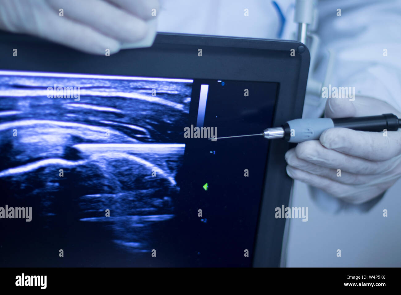 EPI Intratissue Percutaneous Electrolysis dry needling ultrasound ...