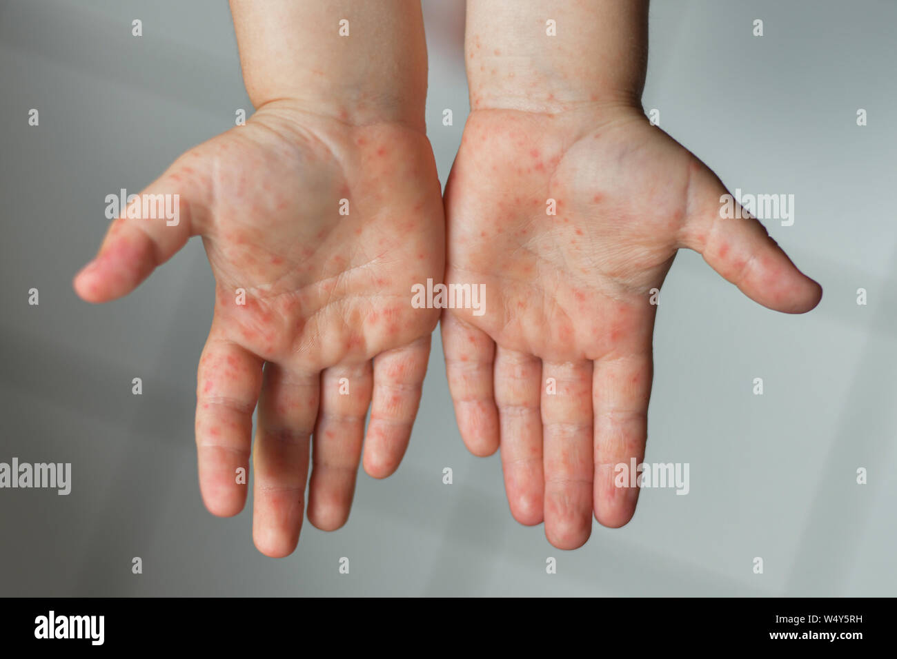 Enterovirus Leg arm mouth Rash on the body of a child Cocksackie virus ...