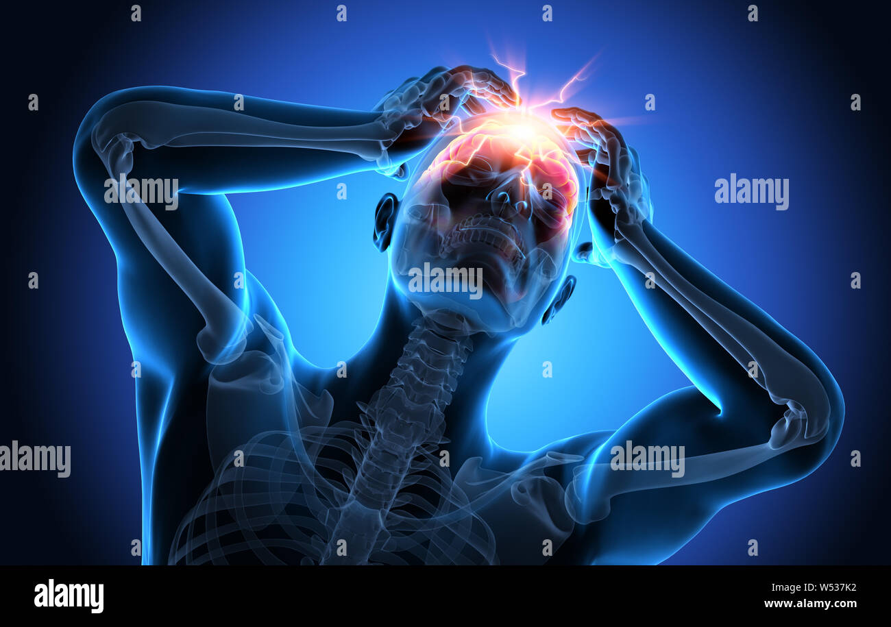 Man with strong headache - Stroke -3D Illustration Stock Photo - Alamy